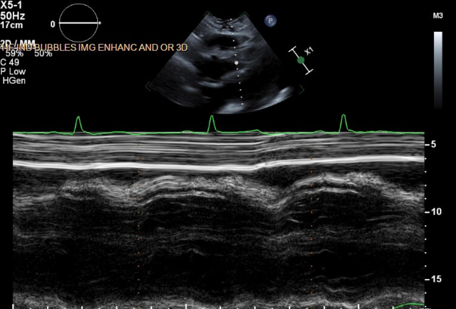 RV Diastolic Collapse – Tamponade Toolbox