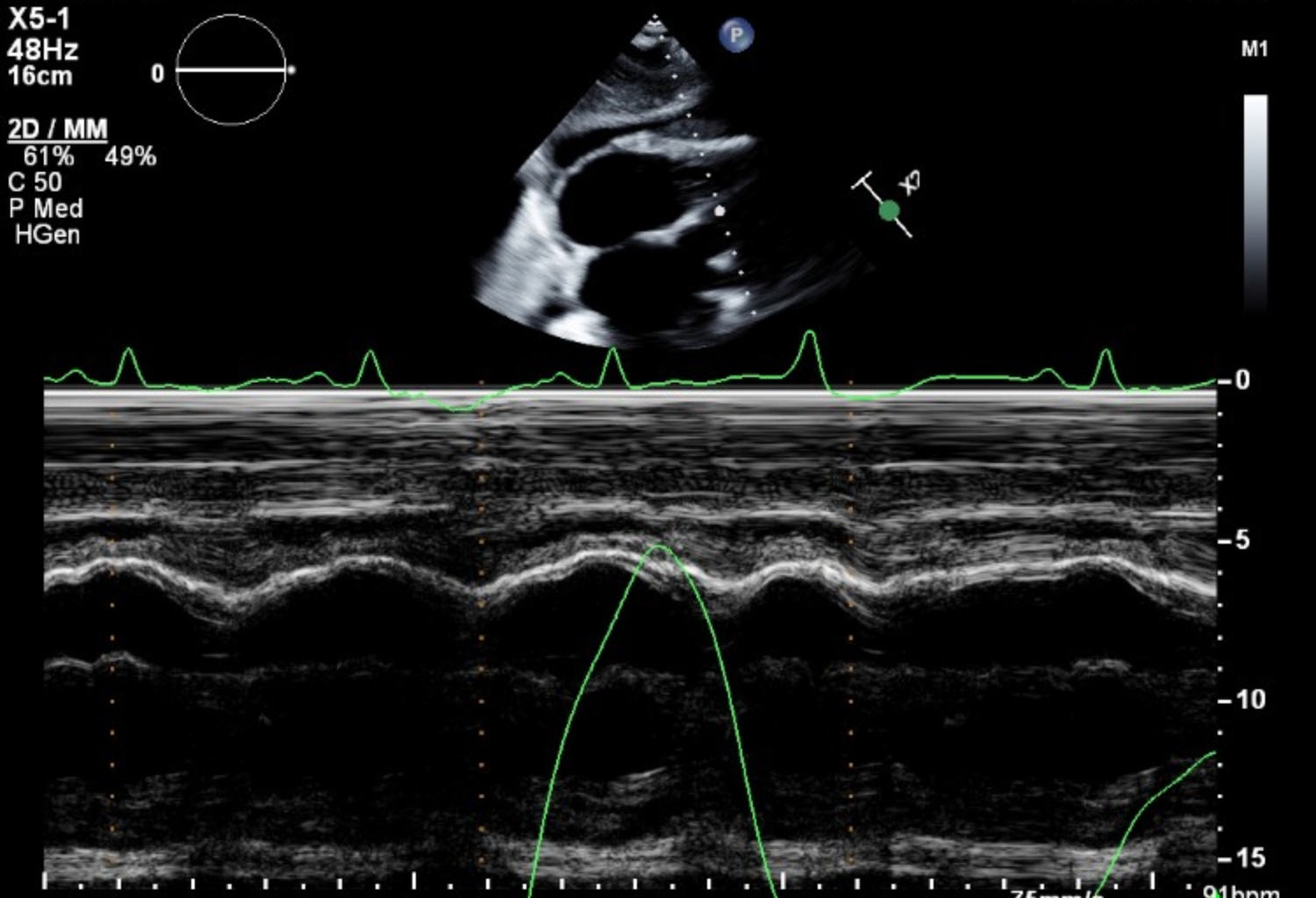 RV Diastolic Collapse – Tamponade Toolbox