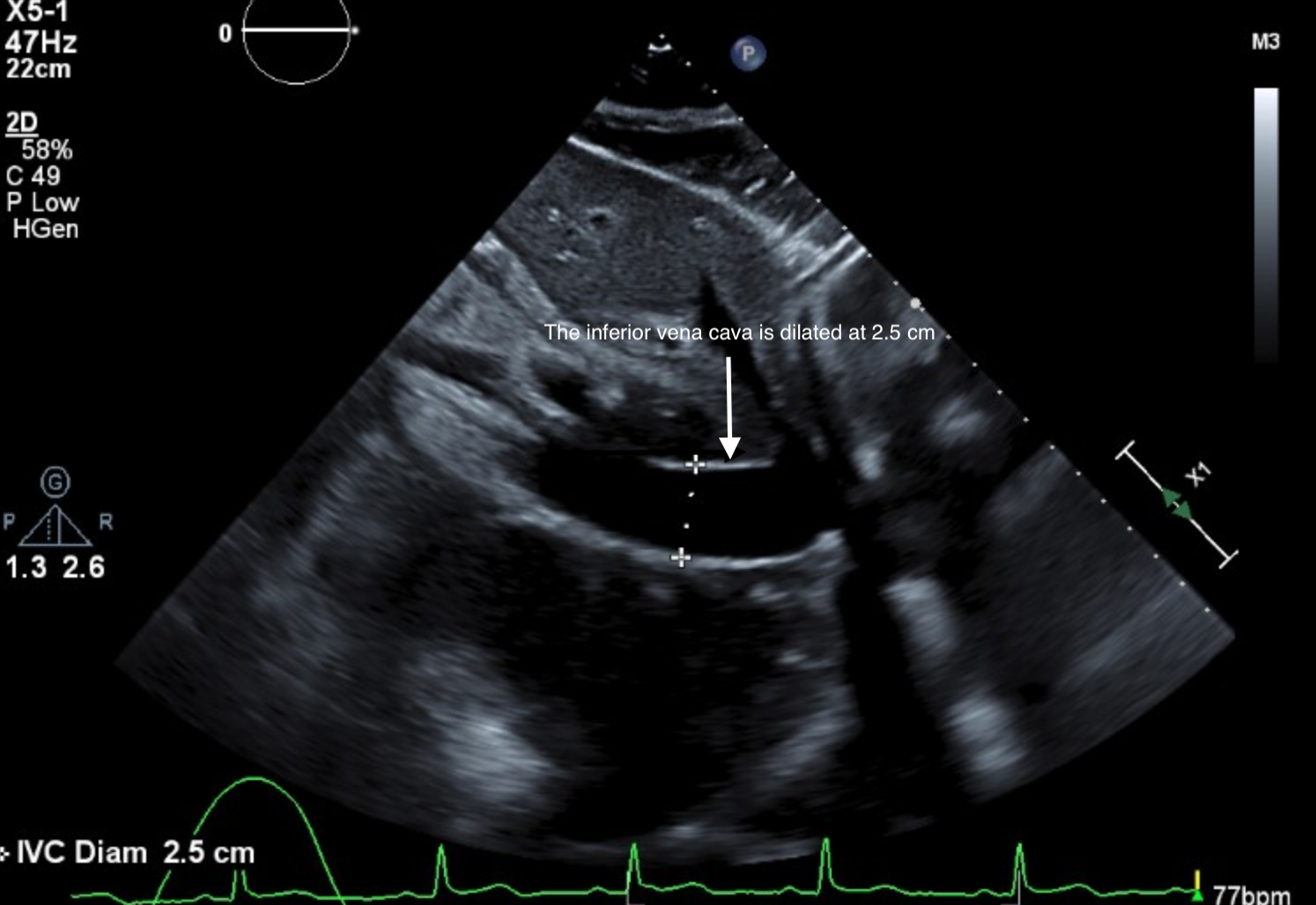 Plethoric IVC – Tamponade Toolbox